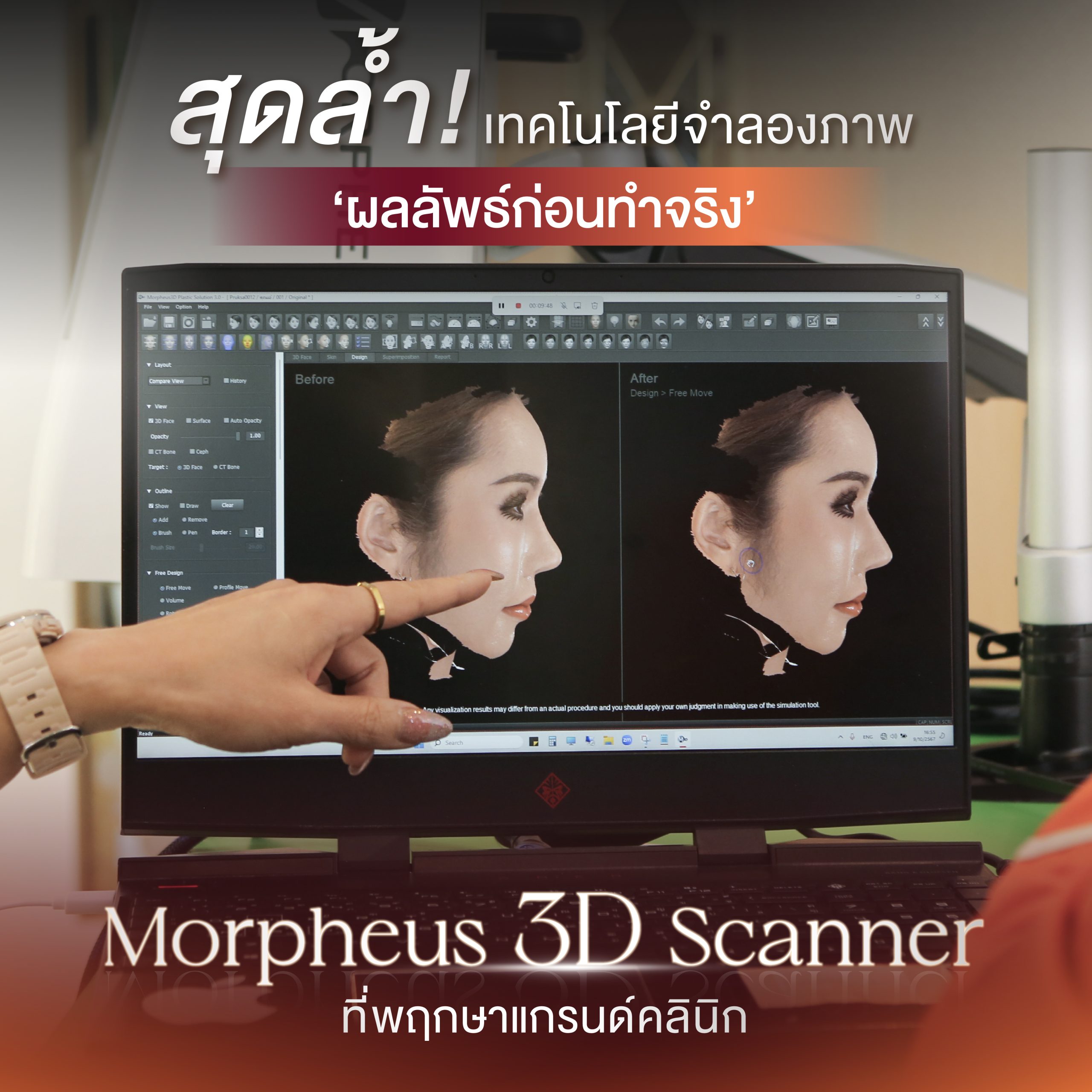 สุดล้ำ! ด้วยเทคโนโลยีความงาม Morpheus 3D Scanner ที่พฤกษาแกรนด์คลินิก ...